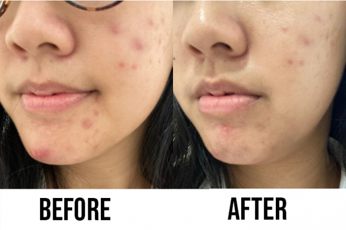 Mentholatum Acnes skincare reviews: 10 readers tried the acne skincare ...