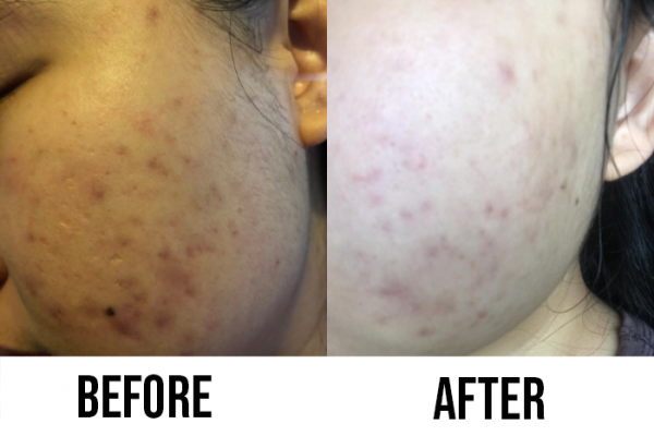 Mentholatum Acnes skincare reviews: 10 readers tried the acne skincare ...