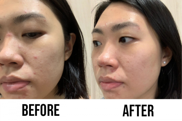 Mentholatum Acnes skincare reviews: 10 readers tried the acne skincare ...