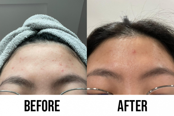 Mentholatum Acnes skincare reviews: 10 readers tried the acne skincare ...