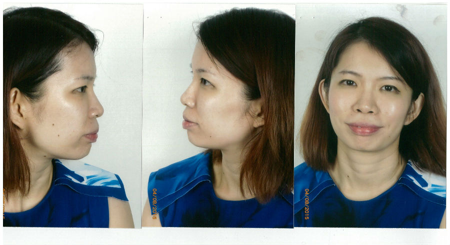 v shape face before 2 - Daily Vanity