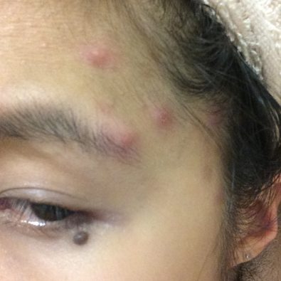 What do the pimples on your face mean & how to prevent them