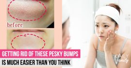Bumps on chin: Here are 5 ways to get rid of closed comedones
