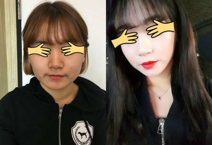 V-line face shape: We examine the different methods to achieve it and ...