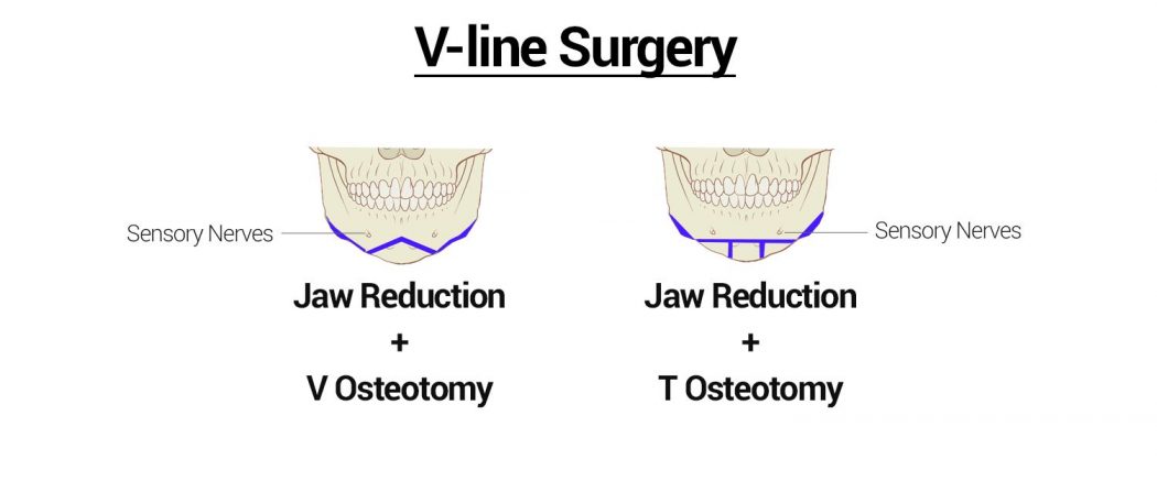 V-line vs Mini V-line Surgery: What’s the difference? | Daily Vanity ...