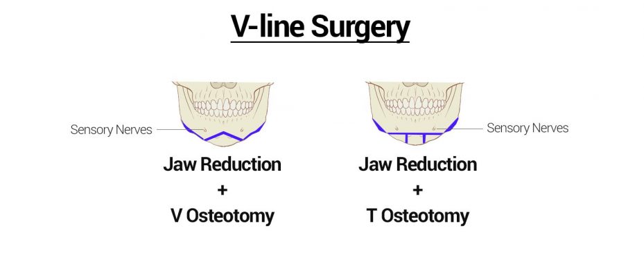 V-line vs Mini V-line Surgery: What's the difference? | Daily Vanity ...