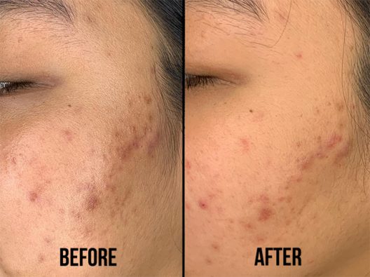 12 Best Extraction Facials in Singapore (2024)