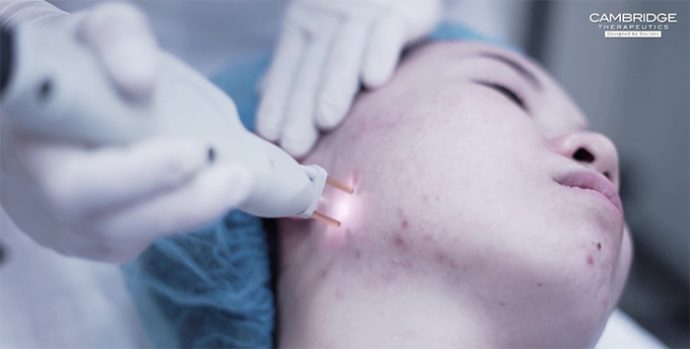 6 best acne facials in Singapore that will save your skin during your ...