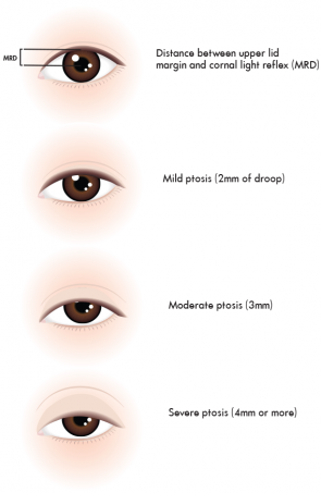 Ptosis Surgery Singapore: All You Need to Know (2024)