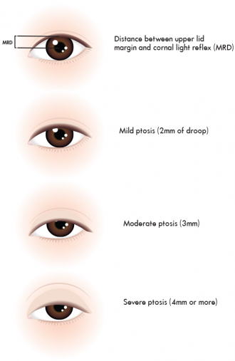 Ptosis Surgery Singapore: All You Need to Know (2024)
