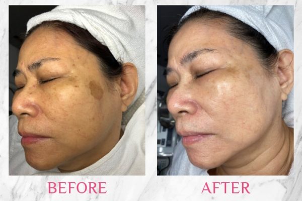 Shakura review: This facial can effectively tackle dark spots that ...