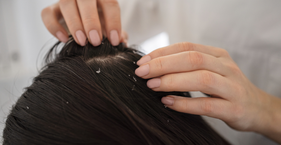 9 Best Dandruff Treatments in Singapore for a Clear Scalp