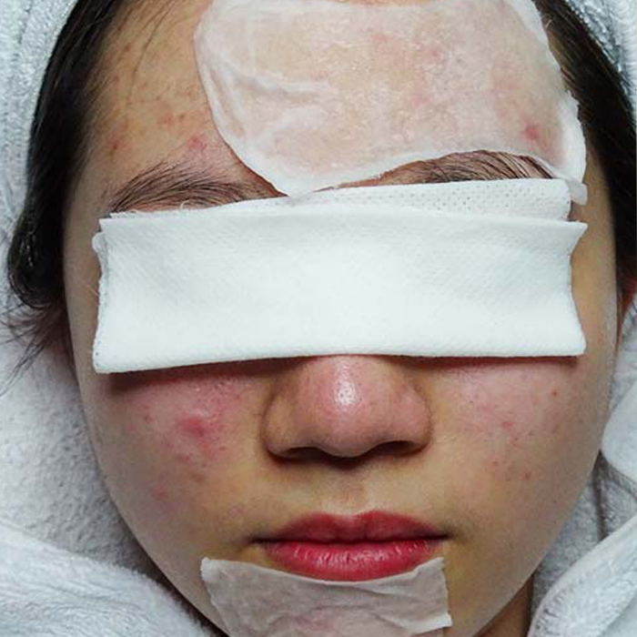4 Best Acne Facials in Singapore: We Review All of Them