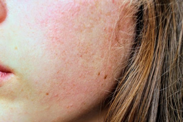 Does dry skin lead to skin sensitivity? We speak to an expert from ...