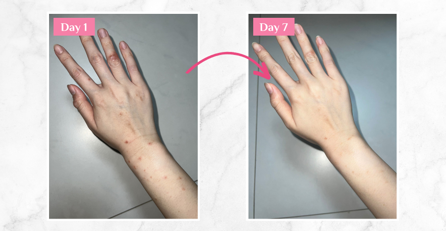 SunoHada reviews: Relieves dry and itchy skin in 7 days