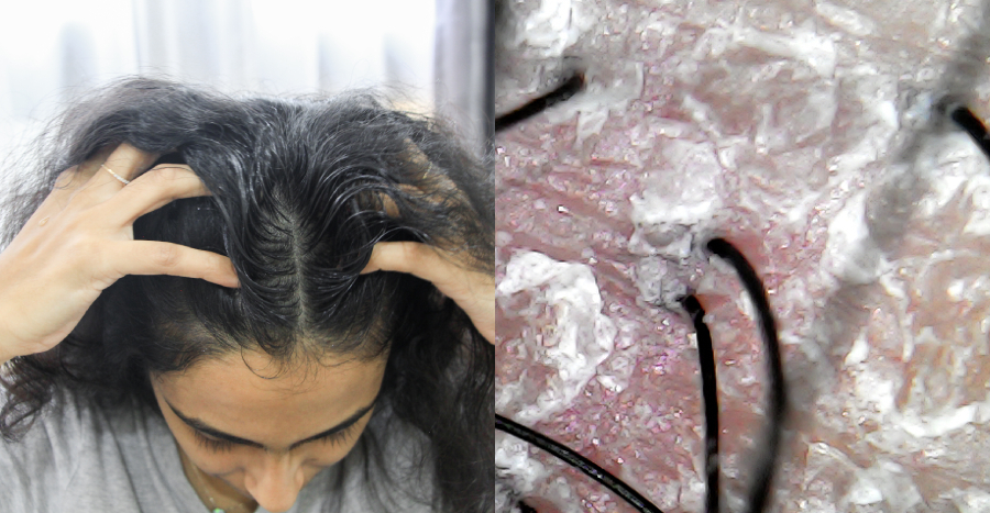 4 signs that you’re suffering from scalp inflammation – and what to do ...