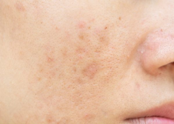 This dermatologist-recommended product lightens stubborn ...