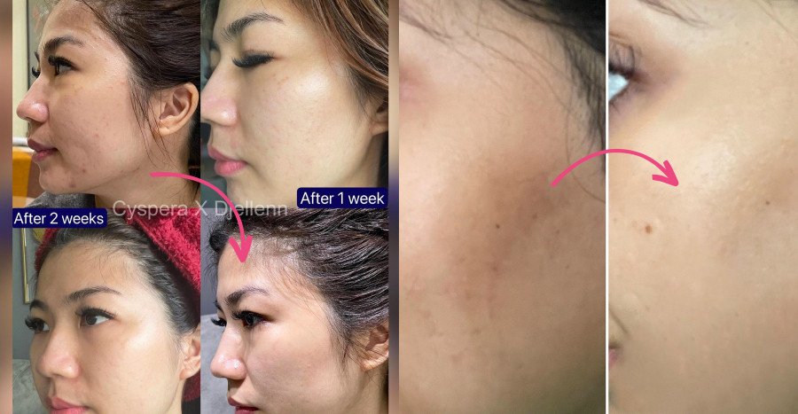This dermatologist-recommended product lightens stubborn ...