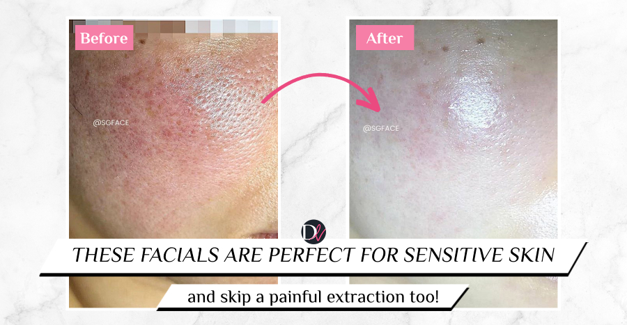 10 best no-extraction facials for sensitive skin, so you can skip the ...