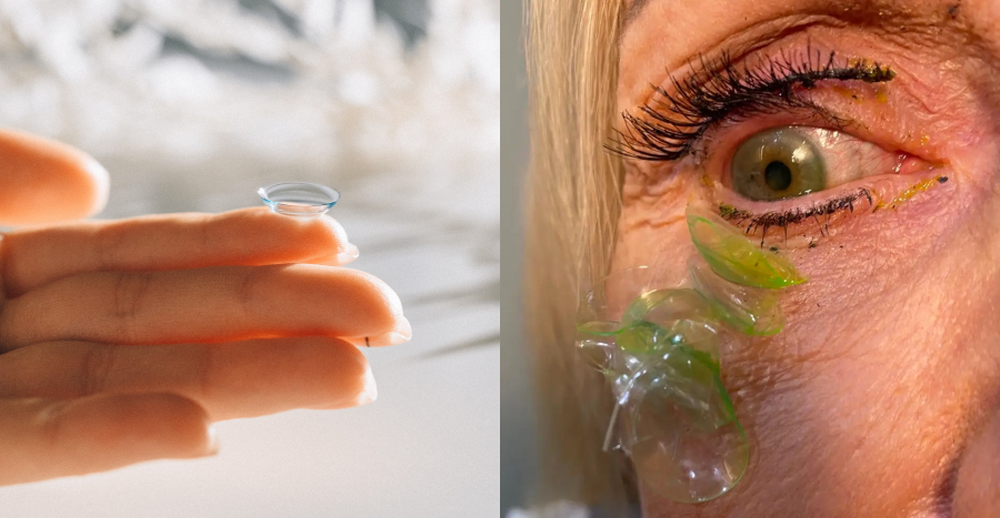 A woman had 23 contact lenses removed from her eye - here's how you can ...
