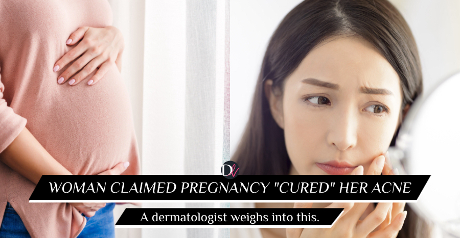 A woman claimed pregnancy “cured” her acne, but could this actually ...