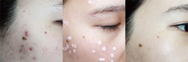 21 Best Pimple Creams To Make Acne Spots Disappear