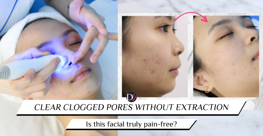 Do acne facials always have to hurt? One DV team member reviews a "pain ...