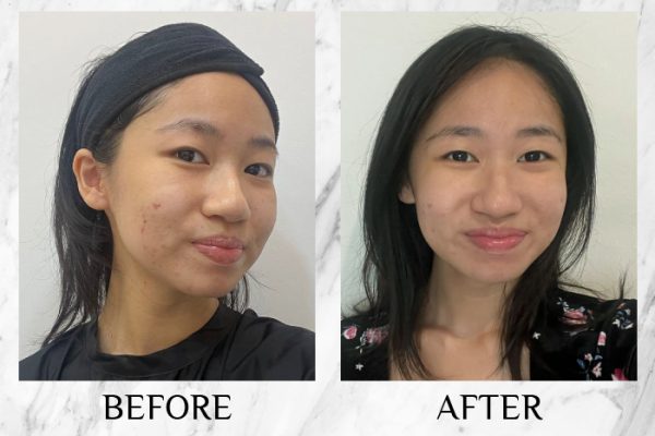 MOXI Laser: We Tried Kim Kardashian’s “Fountain of Youth”