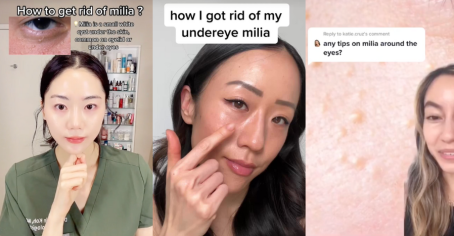 The Best Milia Seeds Removal Treatments in Singapore