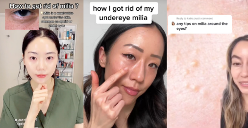 The Best Milia Seeds Removal Treatments in Singapore