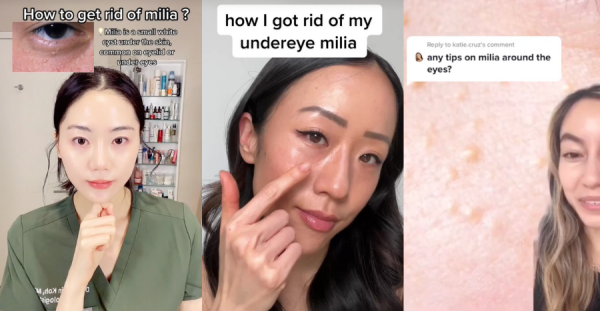 The Best Milia Seeds Removal Treatments in Singapore