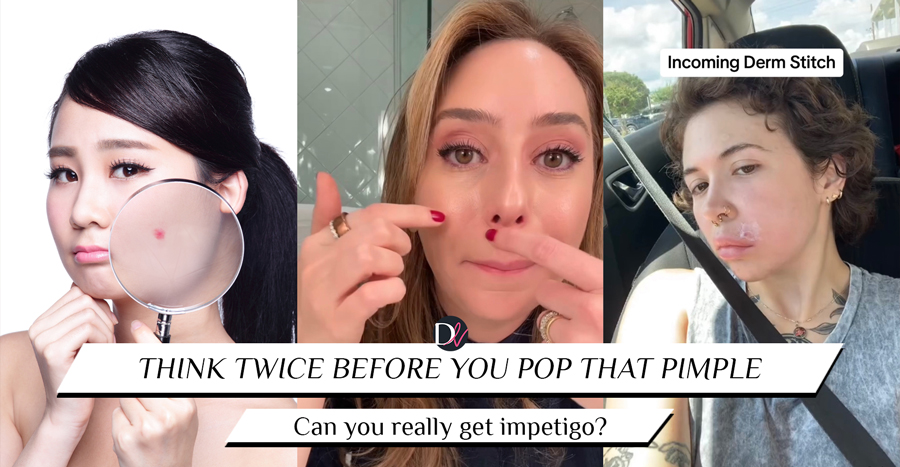 Pimple-popping can lead to a contagious skin infection?! A ...