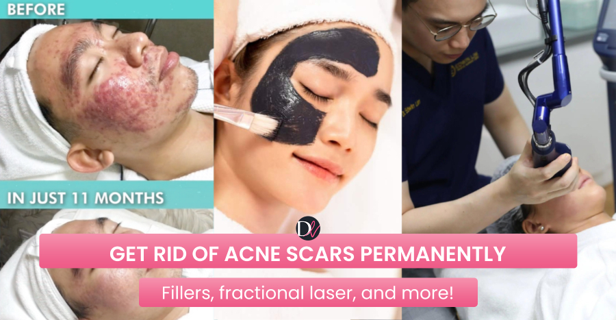 17 Best Acne Scar Treatments in Singapore [2024]