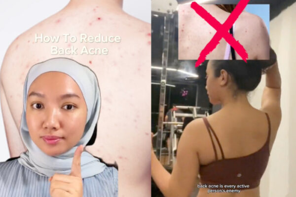 Back Acne (Bacne): 10 Best Treatments, Causes, and More