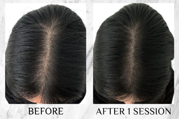 Scalp Micropigmentation (SMP): Benefits & Where to Get It