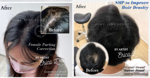 Scalp Micropigmentation (SMP): Benefits & Where to Get It