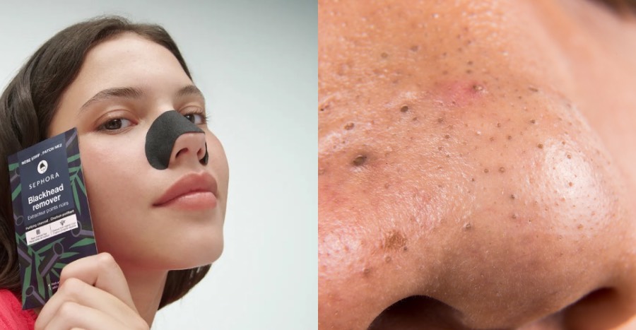 The Best and Easiest Ways To Get Rid of Blackheads and Whiteheads ...