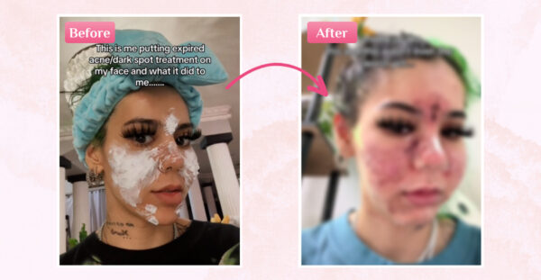 This Content Creator Burned Her Face From Using Expired Acne Cream ...