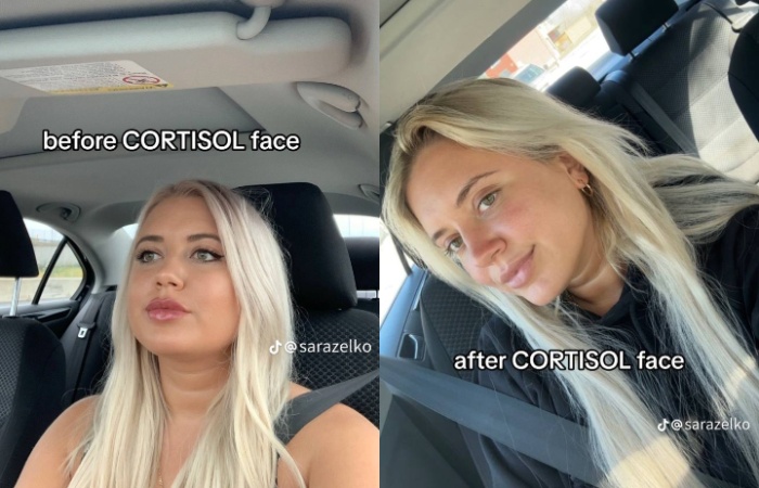 You're Not Overweight, You Just Have Cortisol Face - Here's What You Can Do About It | Daily ...