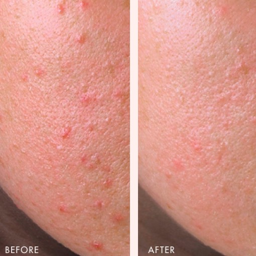 Avène Cleanance Comedomed Peeling Intensive Spot Breakout Cream Review