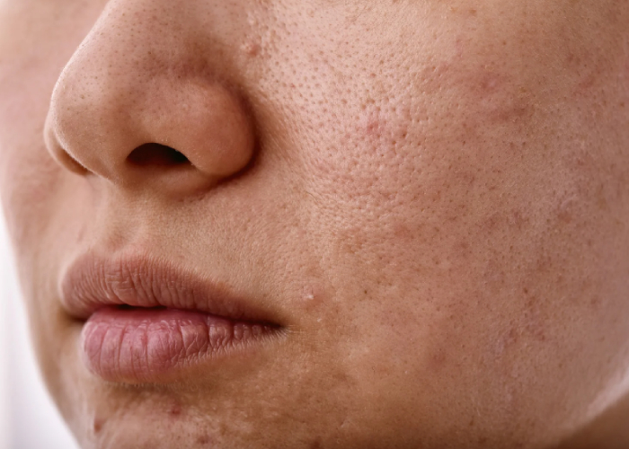 3 Surprising PCOS Skin Symptoms & How to Treat Them