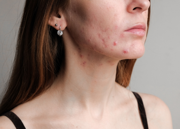 3 Surprising PCOS Skin Symptoms & How to Treat Them