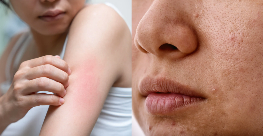 3 Surprising PCOS Skin Symptoms & How to Treat Them