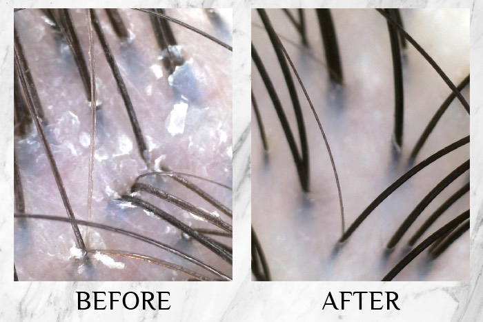 Try TK TrichoKare Scalp Purifying Therapy for Only S$48!