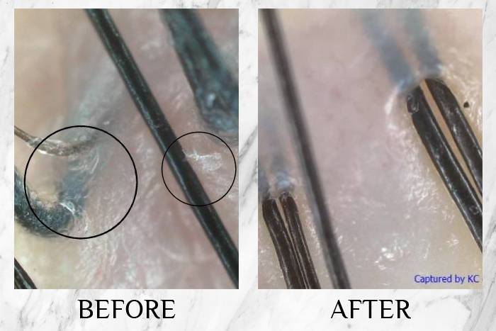 We’ve Found An Effective Hair Loss Treatment for Just S$50! (U.P S$724 ...