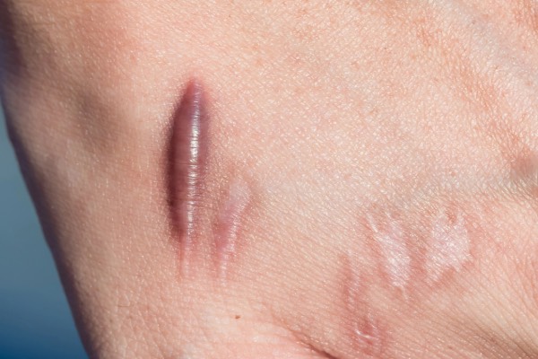 How to Prevent & Reduce C-Section Scar