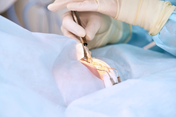 How to Prevent & Reduce C-Section Scar