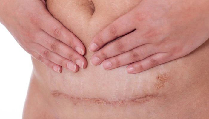 How to Prevent & Reduce C-Section Scar
