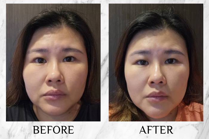 Atelier Kogao Small Face Therapy: Review with Before/After