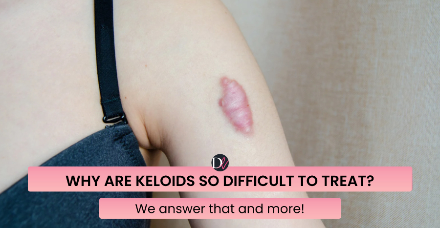 Keloid Scars: How to Best Prevent and Treat Them